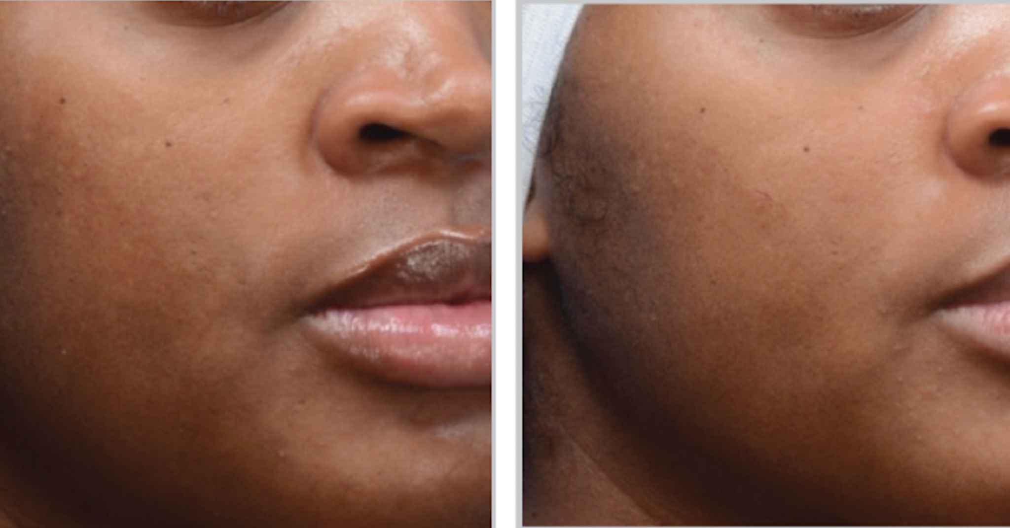 Moxi - Laser Treatment | Maffi Clinics | Scottsdale, AZ